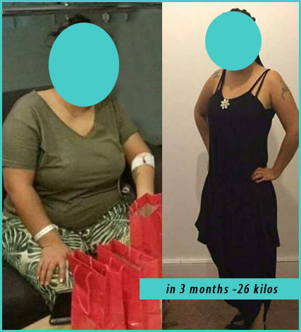 Mini Gastric Bypass - Bariatric Surgery, Weight Loss Surgery