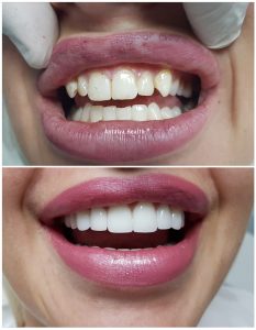 Full Ceramic Crowns | Dental Clinic Turkey, Antalya Dentist